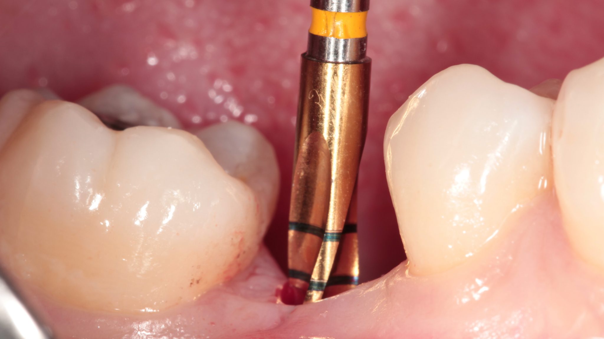 Narrow Diameter Implant in Posterior Mandible | shining3ddental.com