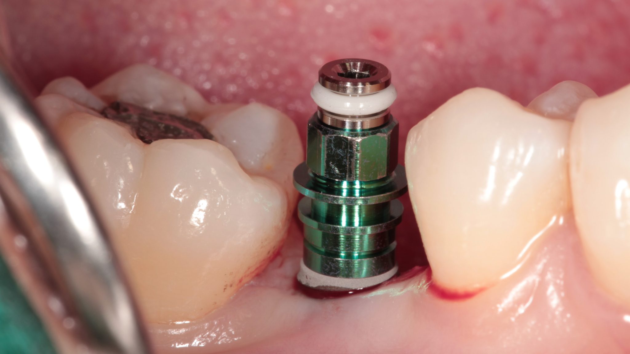Narrow Diameter Implant in Posterior Mandible | shining3ddental.com