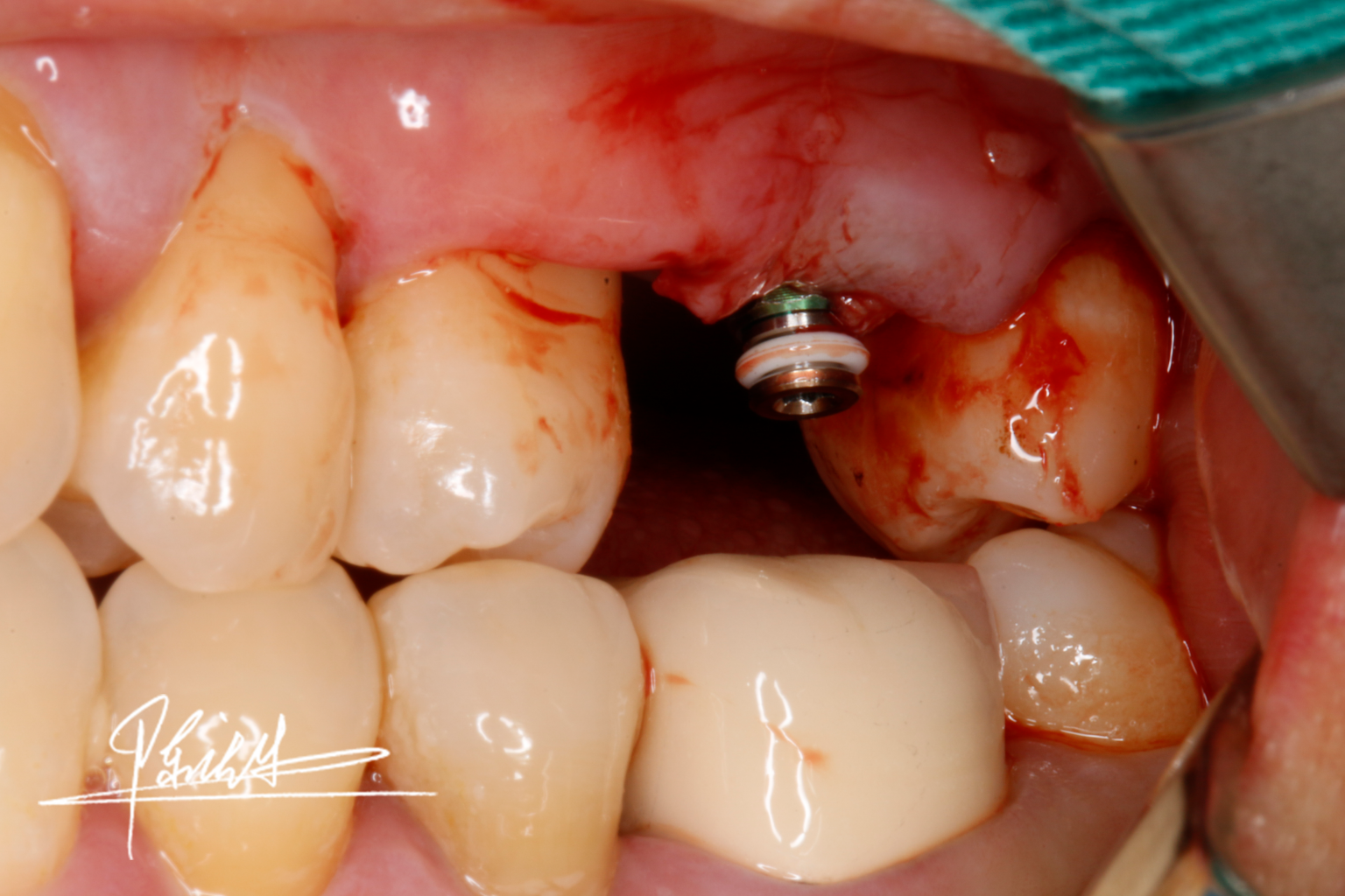 Full digital workflow of Implant Case | shining3ddental.com