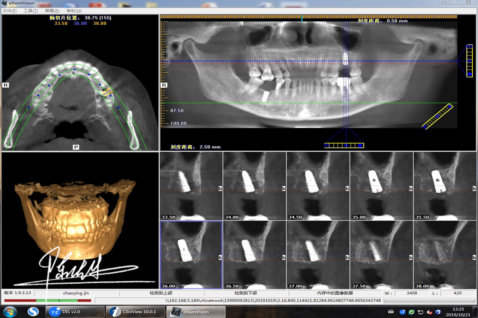 Full digital workflow of Implant Case | shining3ddental.com