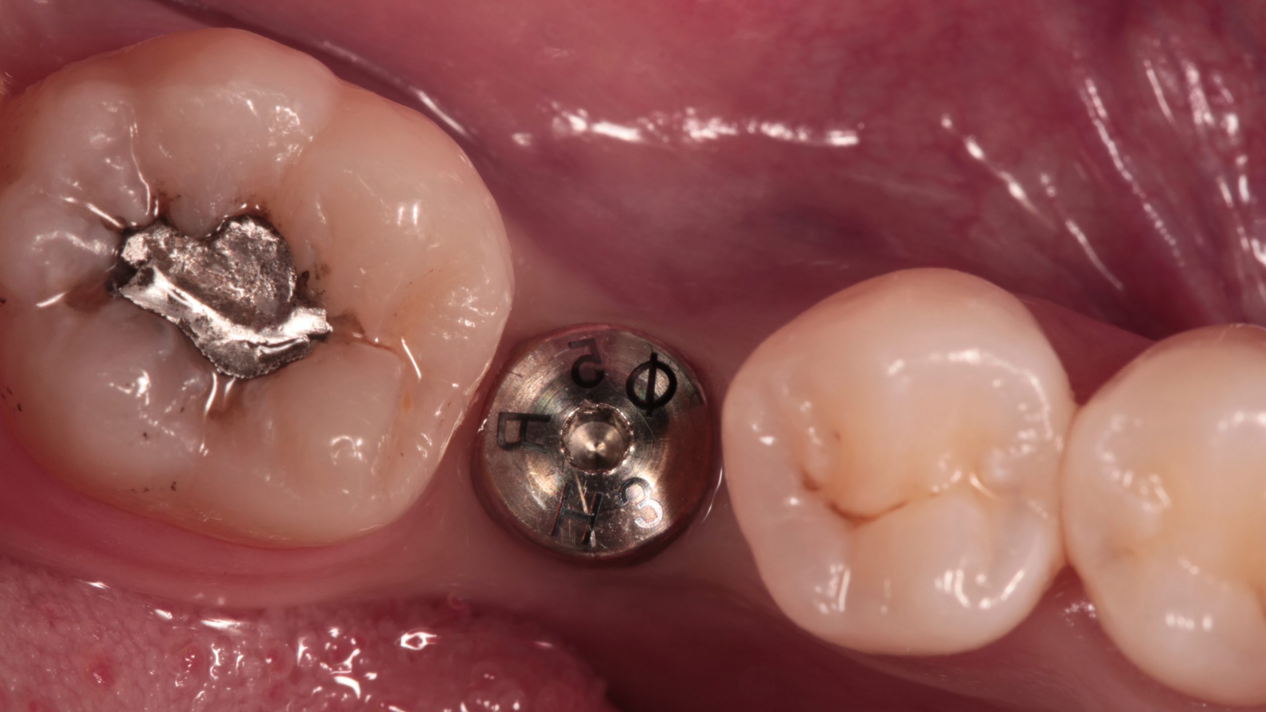 Implantology Between Narrow Posterior Teeth | shining3ddental.com